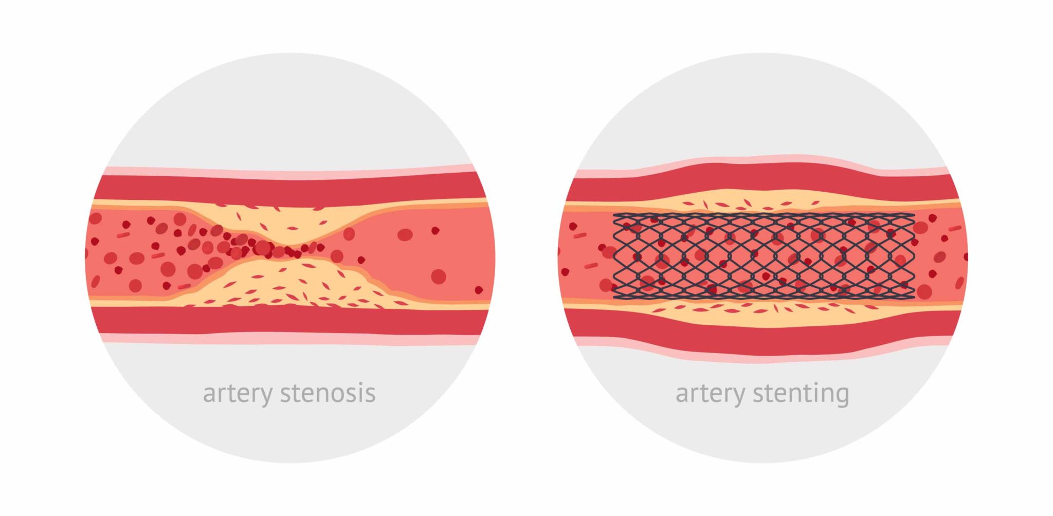 Stent for coronary vessels - THE IMPLANT REGISTER