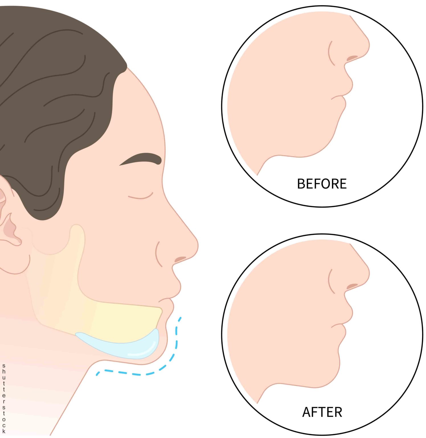 PATIENT INFORMATION: Aesthetic / Contour Implants – THE IMPLANT REGISTER