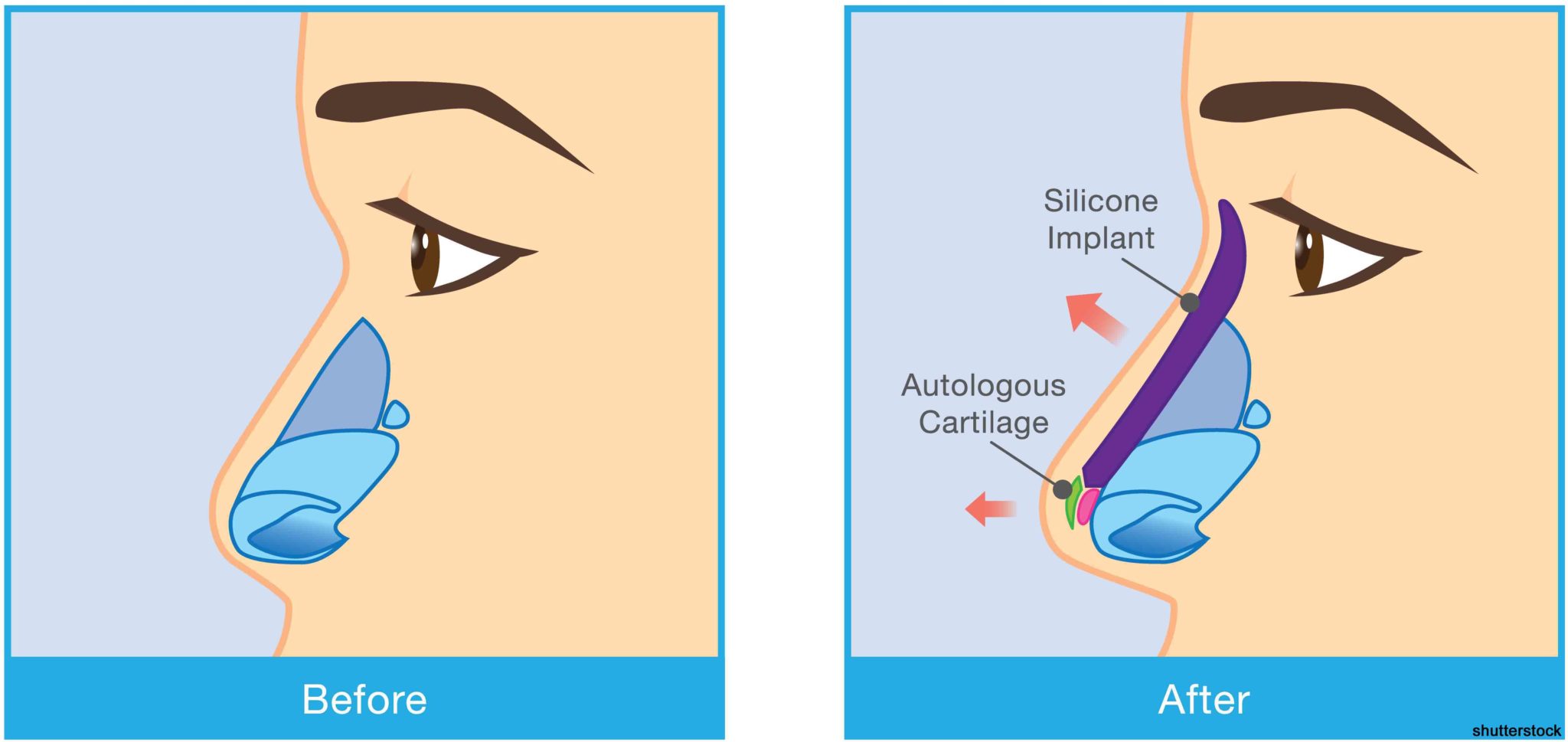 PATIENT INFORMATION: Aesthetic / Contour Implants – THE IMPLANT REGISTER