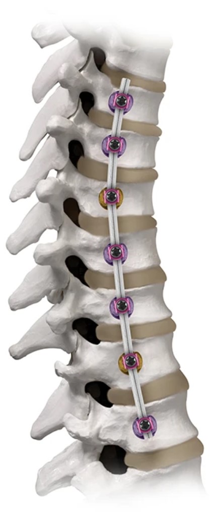 REFLECT™ Scoliosis Correction System - THE IMPLANT REGISTER